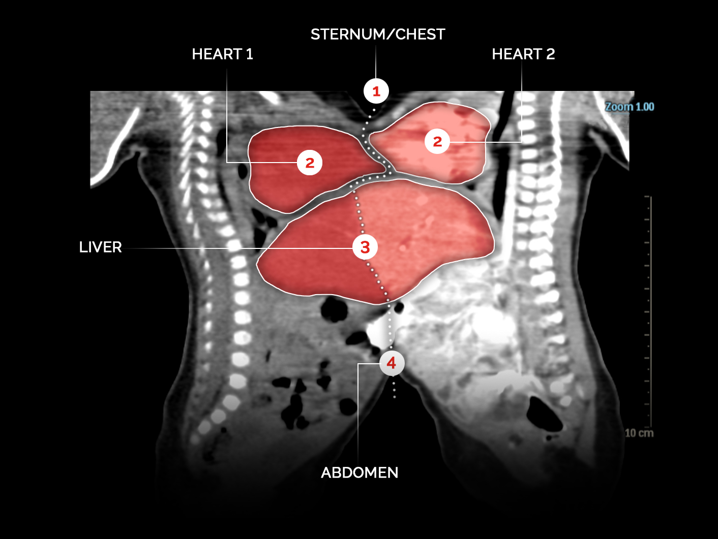 Formerly Conjoined Twins Now Happy and Healthy, Defying All Odds - Hey ...